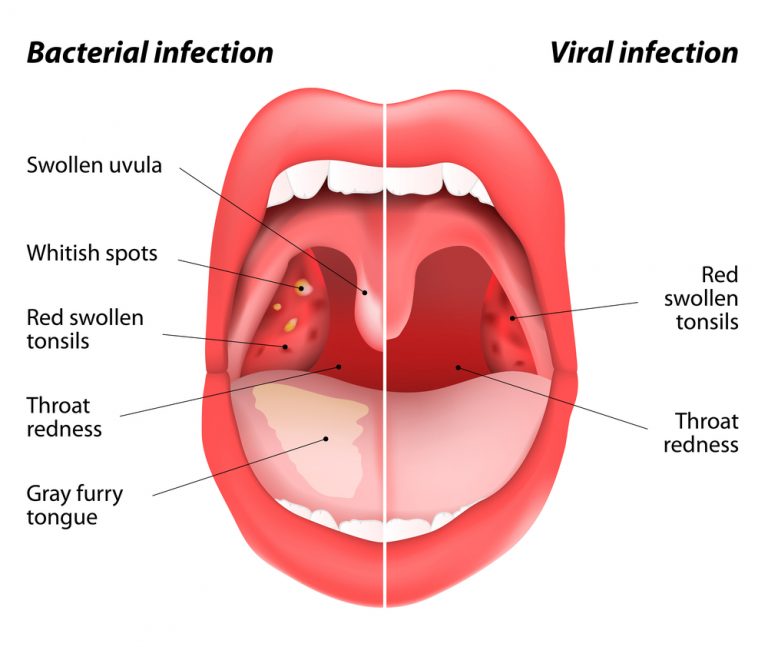 Tonsil Berbahaya Jika Tidak Di Cegah, Ini Punca Dan Rawatannya
