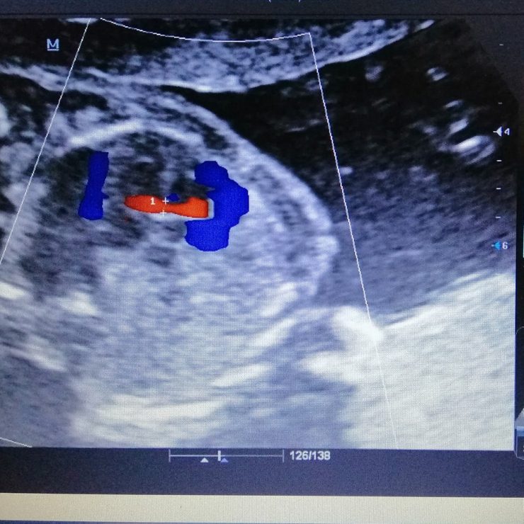 "Ni Lagi Penting Dari Buat Scan Nak Tengok Bayi Ikut Hidung Mak Ke ...