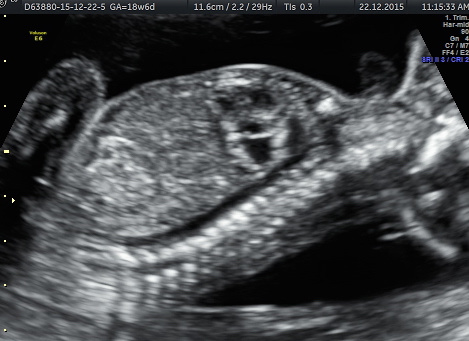 "Ni Lagi Penting Dari Buat Scan Nak Tengok Bayi Ikut Hidung Mak Ke ...