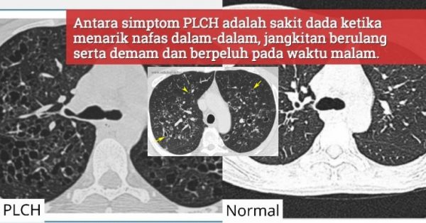 Doktor Kongsi Gambar Paru-Paru Berlubang, Tabiat Merokok Antara Punca ...
