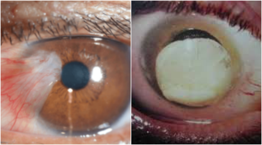 Kanta Mata Keputihan Dan Boleh Jadi Buta, Ini Boleh Jadi Punca Katarak ...