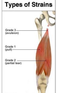 "Cepat-cepat Letak Ais Dan...”, Fisioterapi Kongsi Macam Mana Nak Tahu ...