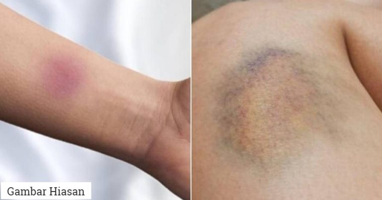 Betul Ke Badan Tiba-Tiba Lebam Sebab Benda 'Mistik'? Ini Penjelasan Doktor