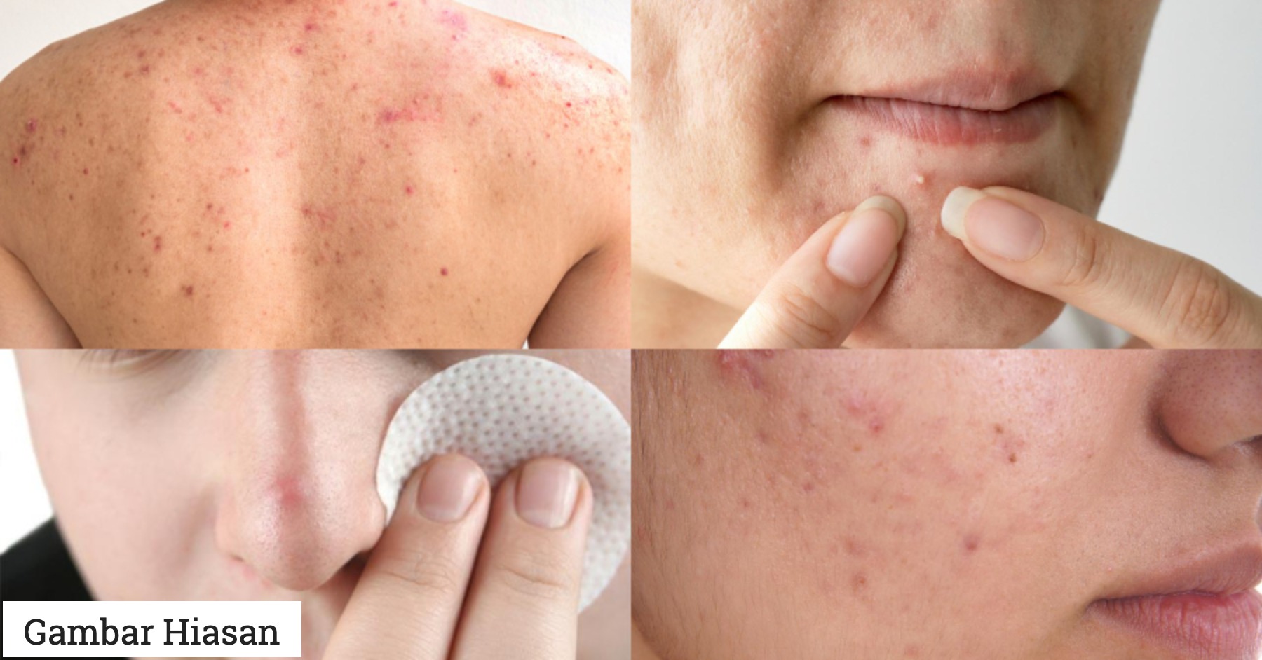 Lain Tempat Lain ‘penyebabnya Ini Mungkin Punca Jerawat Tumbuh Di Dahi Hidung Pipi Dagu Dan