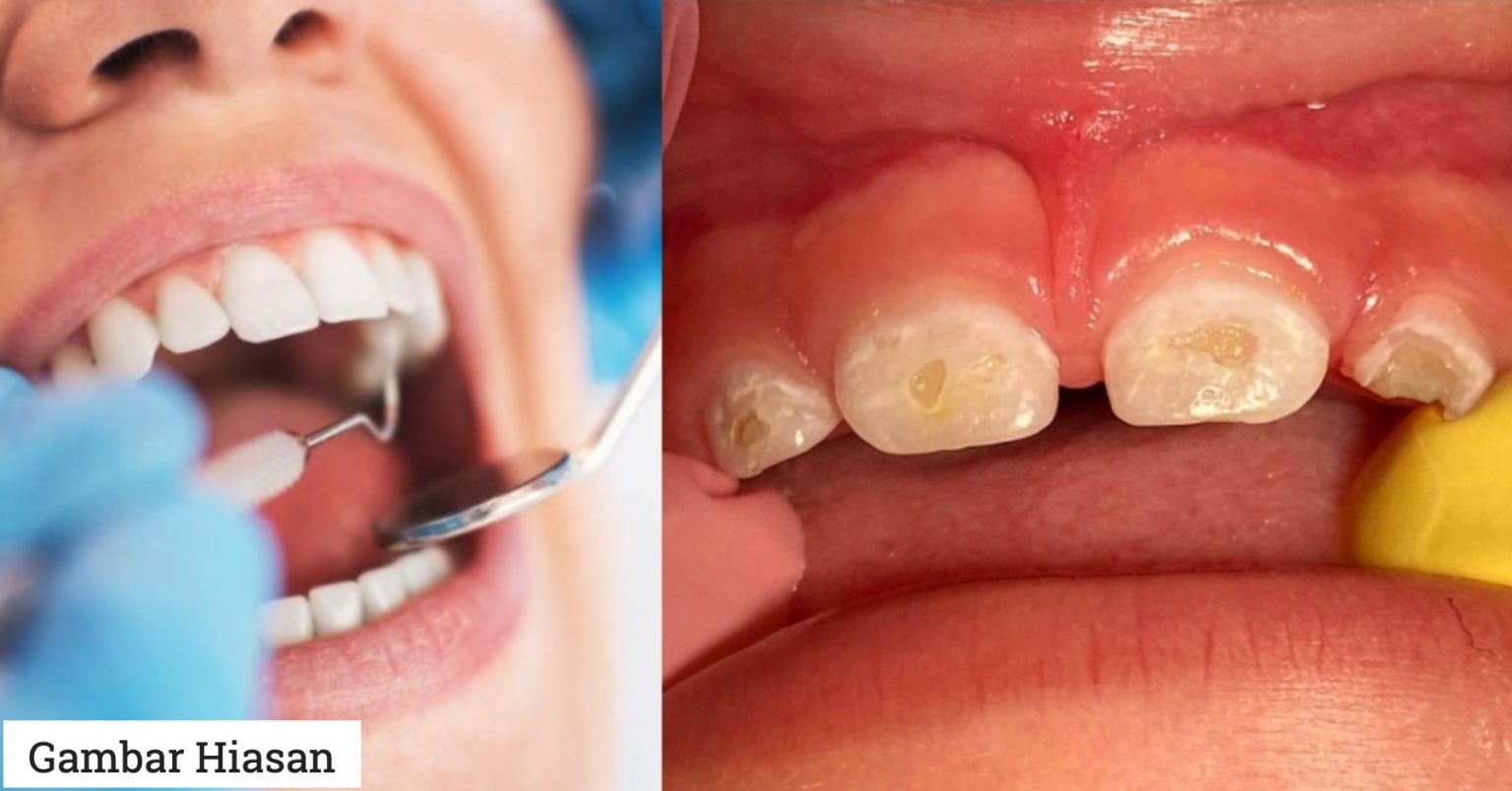 Kesan Lubang Bukanlah Punca Awal Gigi Rosak, Doktor Dedahkan Tanda ...