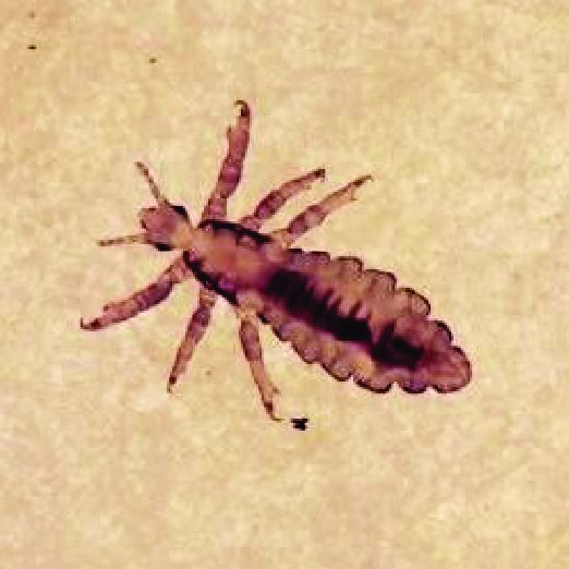 Awas, Kutu Kepala Boleh Sebabkan Penyakit Kulit, Kenali 3 Jenis ...