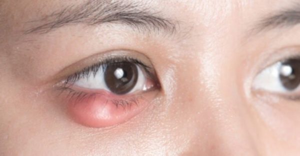 Malu Mata Tumbuh Ketumbit? Jangan Risau, Cuba Lima Solusi Mudah Ini