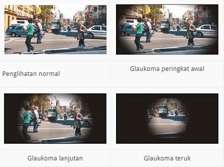 "Mak, Tak Nampak Pun Benda Tu...", Pelbagai Jenis Masalah Penglihatan ...