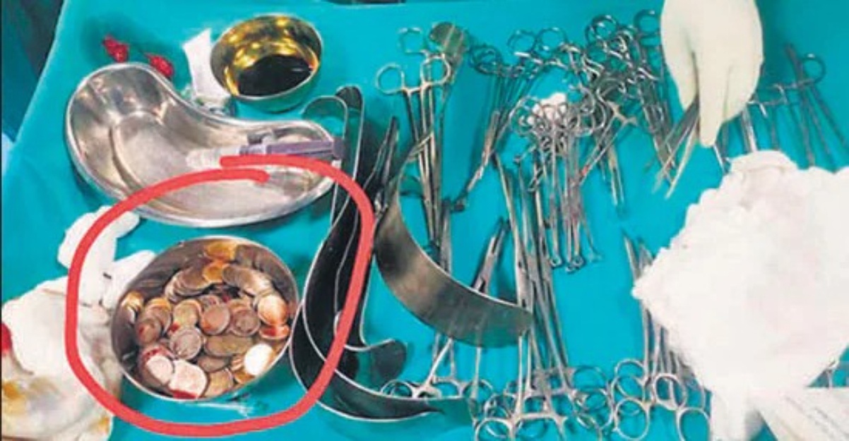 187 Kepingan Syiling Berjaya Dikeluarkan Dari Perut Pesakit Skizofrenia