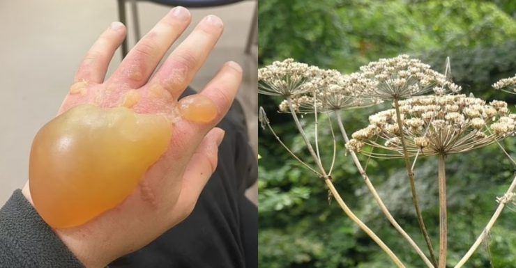 Tangan Lelaki Lepuh Sebesar Buah Oren Lepas Sentuh Tumbuhan Berbahaya