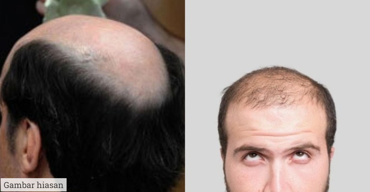 Pelik Kenapa Lelaki Je Selalu Botak, Perempuan Tak? Ini Jawapannya