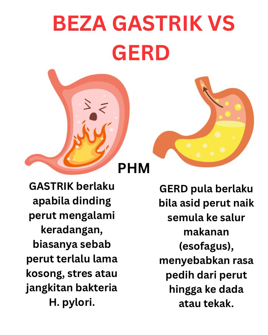 Ketahui Perbezaan Antara Gastrik Dan GERD